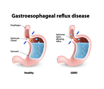 The Effects of Pulsed Therapeutic Plasma Exchange on Gastrointestinal ...