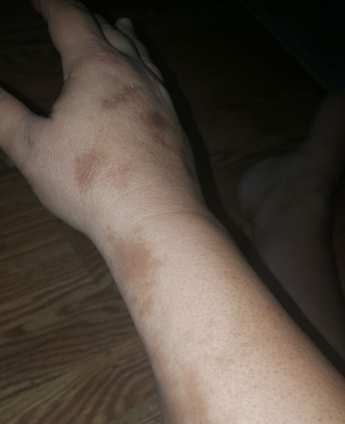 Differential Diagnosis - Scleroderma Education Project