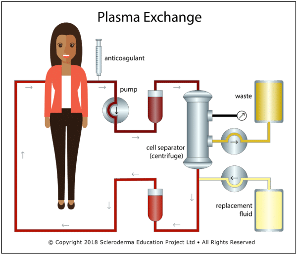Therapeutic Plasma Exchange as a Treatment for Systemic Sclerosis ...