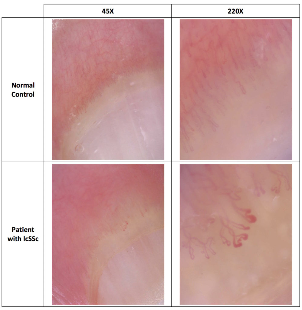 Nailfold capillary examination in systemic sclerosis